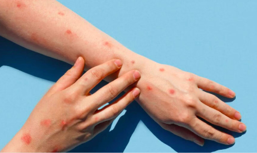 São José dos Campos tem o segundo caso de varíola do macaco confirmado